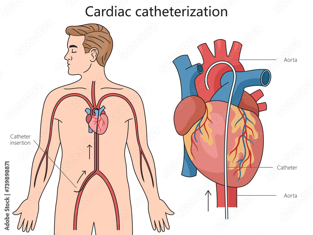 Cardiac catheterization structure diagram hand drawn schematic raster illustration. Medical ...