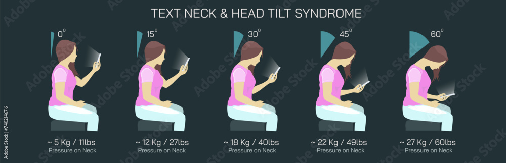 Text Neck Syndrome of phone posture is the onset of cervical spinal ...