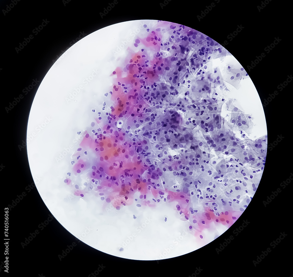 Gardnerella vaginalis infection pap smear under microscopy. Stock Photo ...