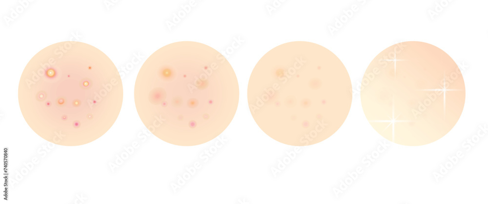 Before and after pimples, acnes isolated background, skincare problem ...