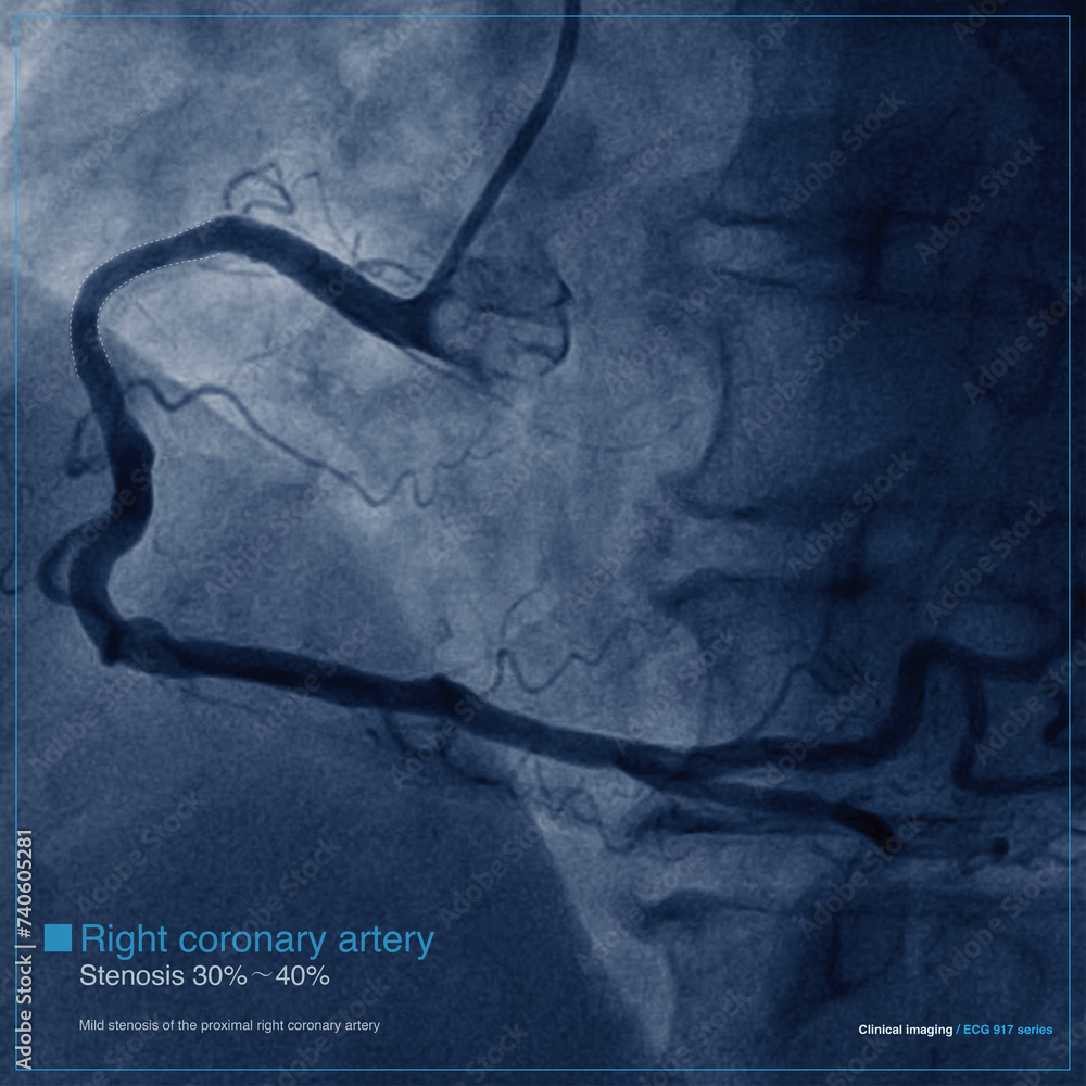 This coronary angiography showed mild stenosis of the proximal right ...