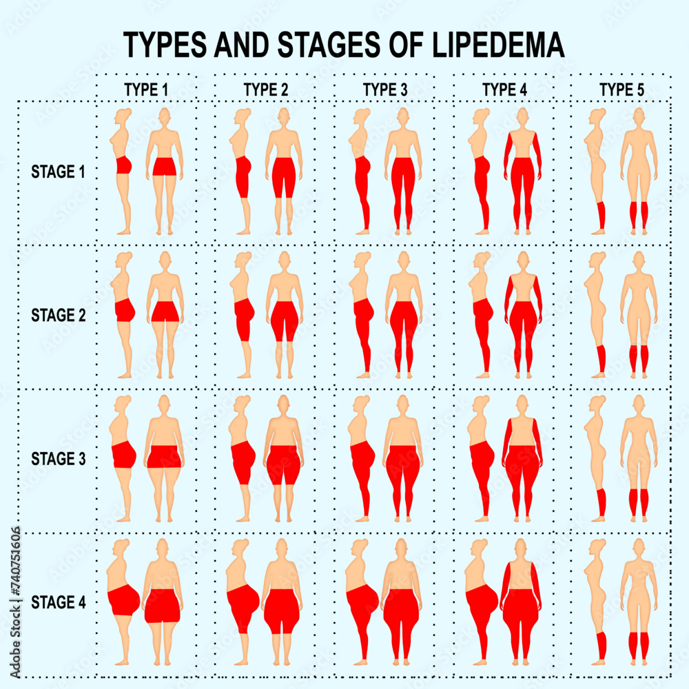 Types and stages of Lipedema medical illustration demonstration Stock ...