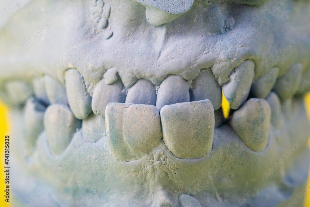 Blue plaster impression of the dental jaw of a patient with crooked ...