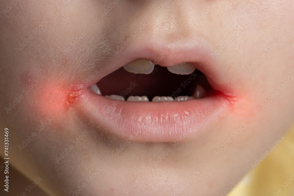 slit-like impetigo in a little girl in the corners of her mouth. Skin ...