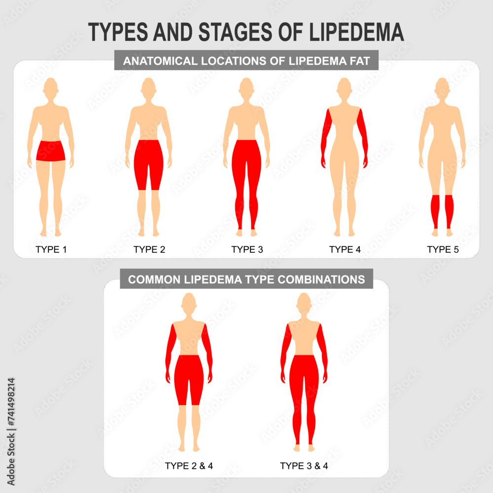 Lipedema Types and Stages condition Stock Vector | Adobe Stock