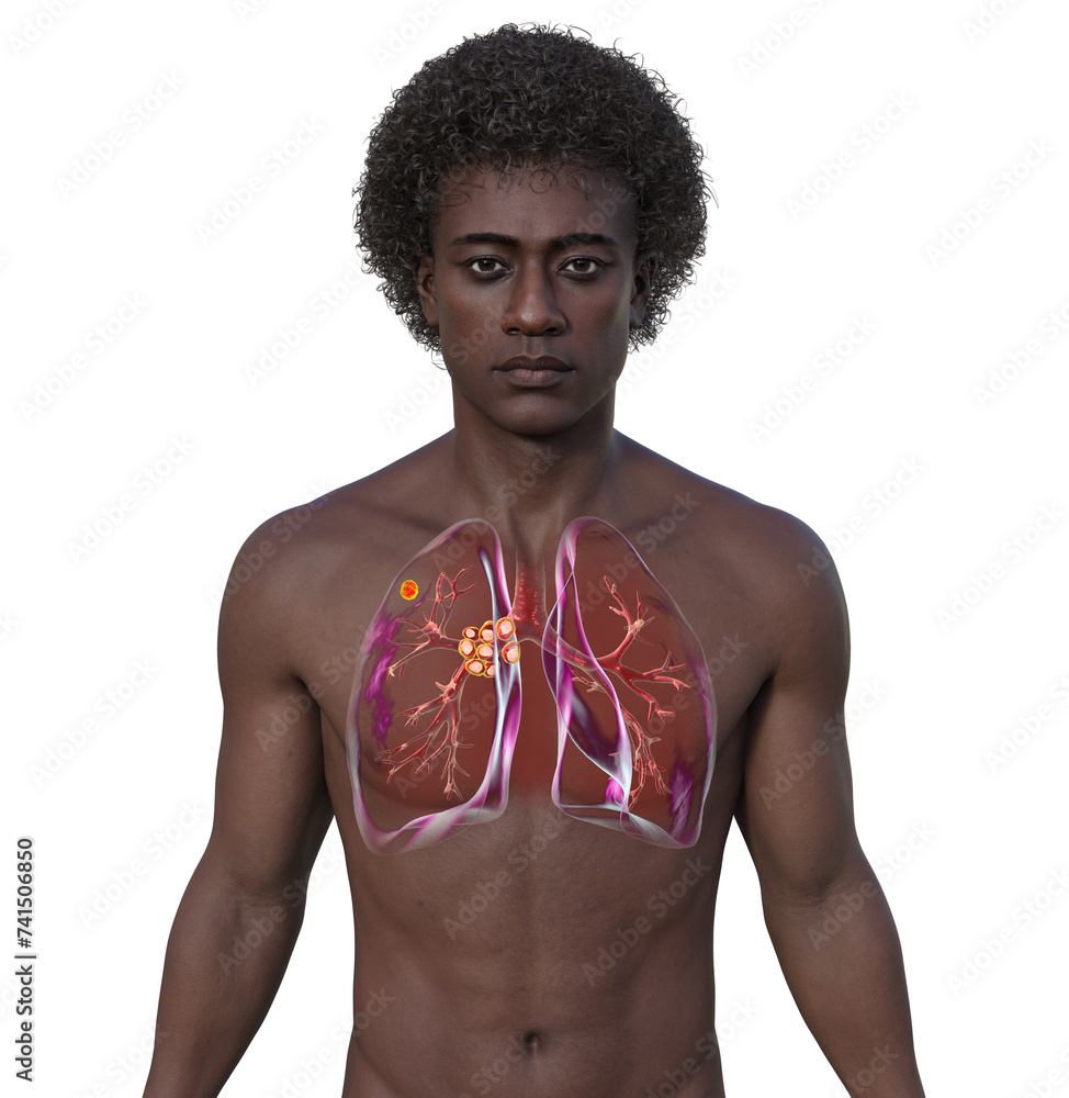 Poster Primary lung tuberculosis in a man with the Ranke complex, 3D ...