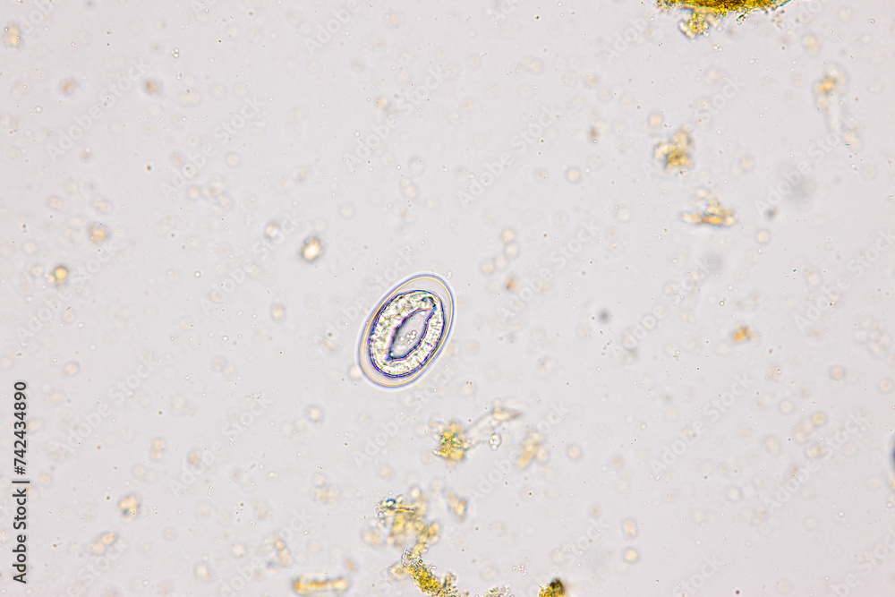 Finding Trichuris trichiura egg and Strongyloides egg in the feces ...