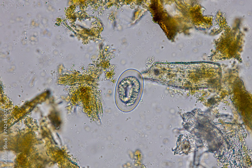 Finding Trichuris trichiura egg and Strongyloides egg in the feces ...