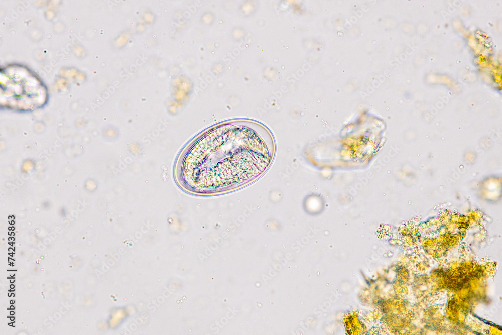 Finding Trichuris trichiura egg and Strongyloides egg in the feces ...