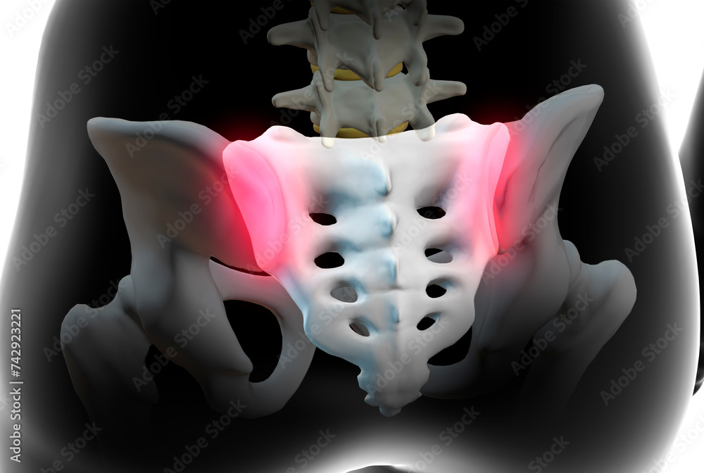Inflammation of sacroiliac joints, called Sacroiliitis, causing pain in ...