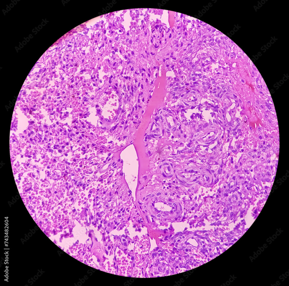 Ovarian cyst: Haemorrhagic cyst. Microscopic show ovarian cyst wall of ...