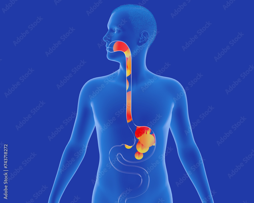 Anatomical 3D illustration of the stomach and esophagus with reflux to the mouth. With ardor and ...