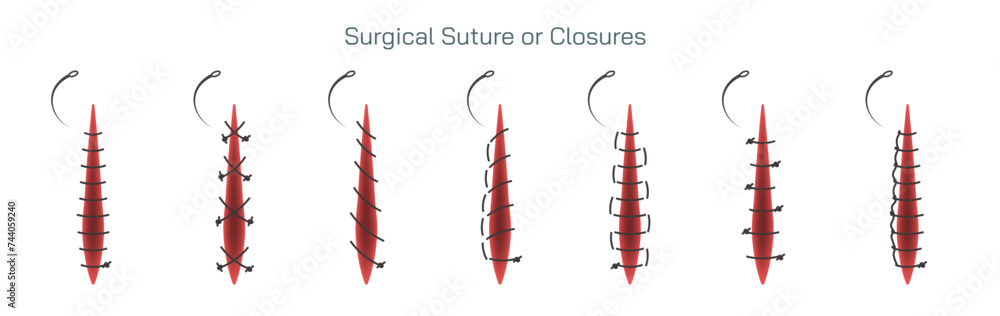Vecteur Stock Types of surgical sutures vector illustration. Suture are ...