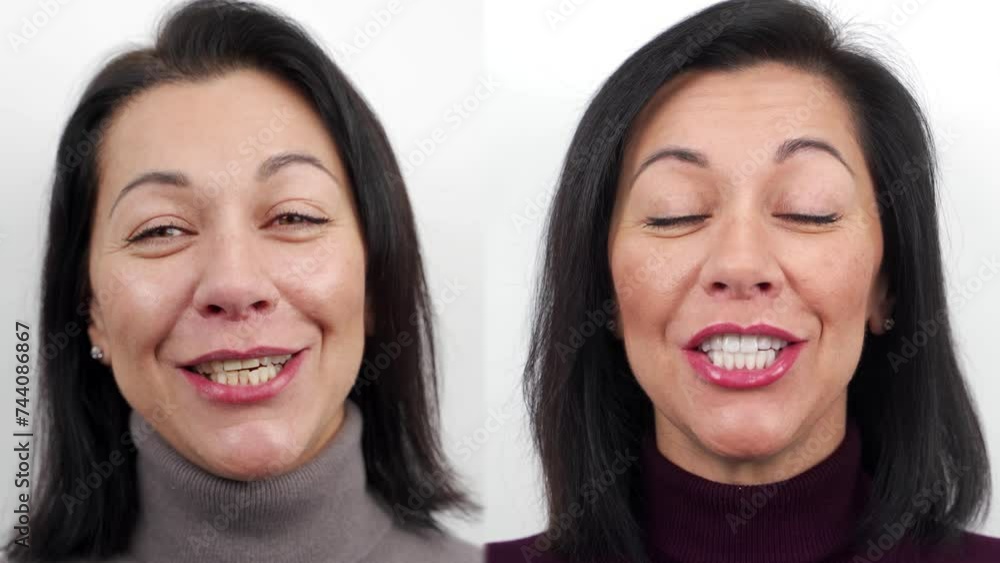 Woman before and after zirconia veneers, dental ceramic crowns. Female ...