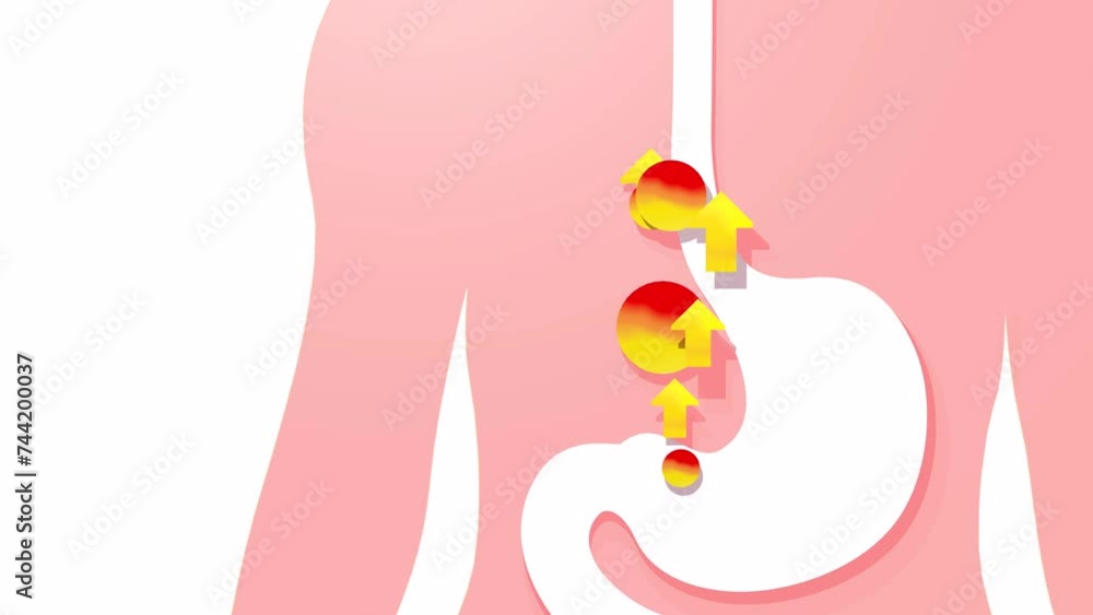 3d animation of esophagus with gastric reflux and heartburn. With ...
