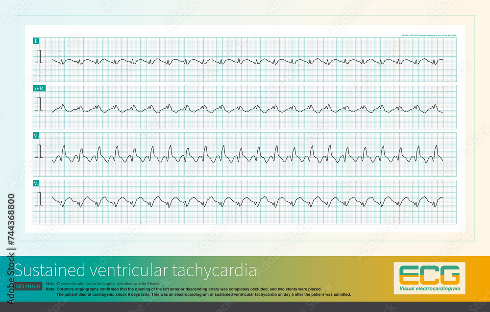 Male, 52 years old, diagnosed with acute extensive anterior wall ...
