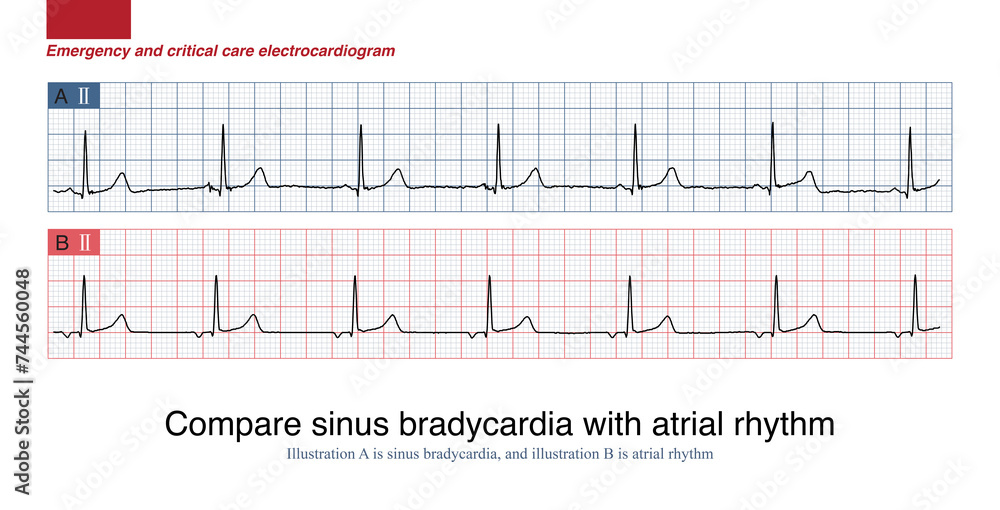 When sinus bradycardia is found, one of the important differential ...