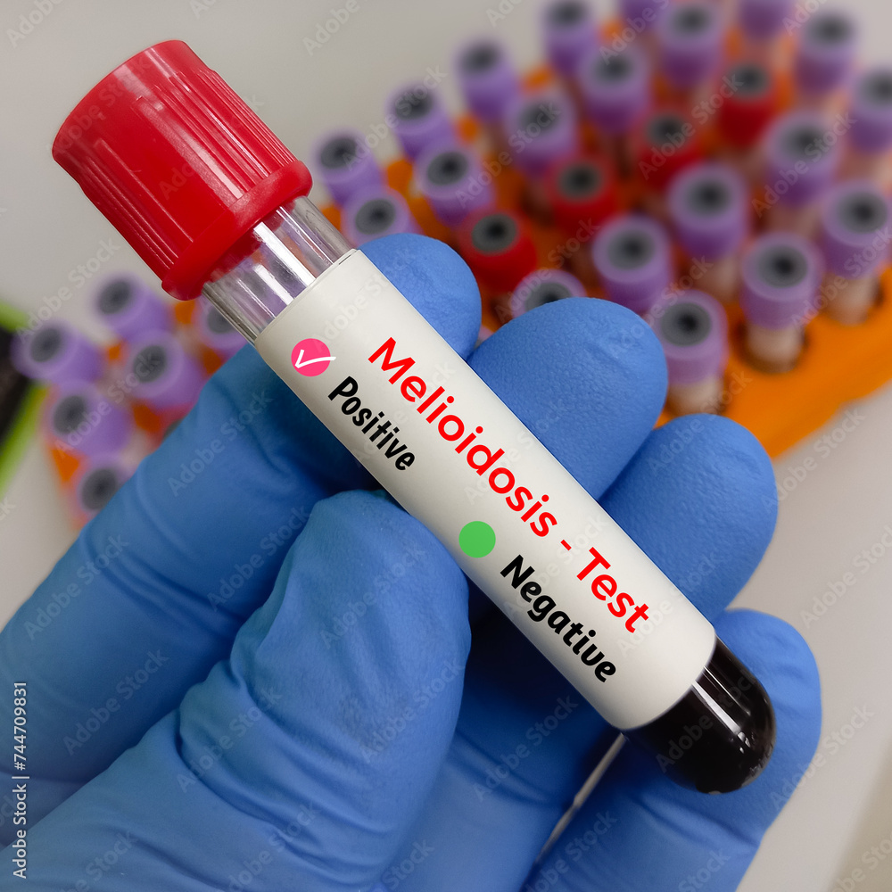 Blood sample for Melioidosis test, also called Whitmore's disease ...