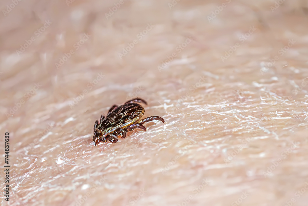tick digging into human skin close-up of a. Tick season and lyme ...