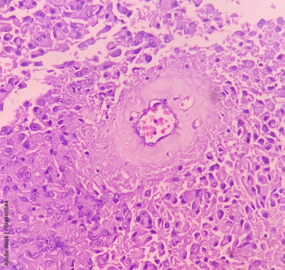 Astrocytoma, Intramedullary SOL (C5-D3) tissue biopsy. Photomicrograph ...