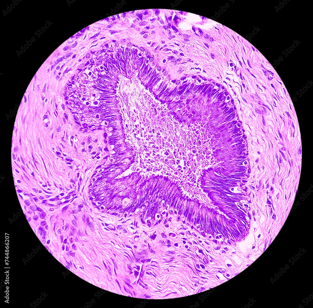 Uterus with adnexa (biopsy): Cervix show chronic inflamatory cells ...