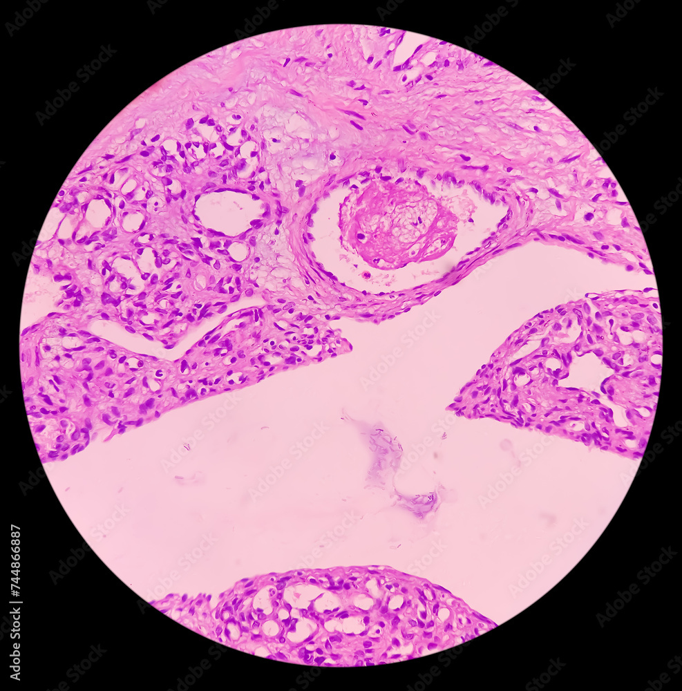 Swelling of middle finger (biopsy). Lobular Capillary hemangioma. A ...