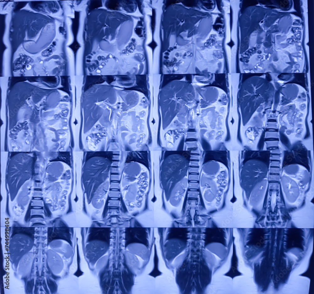 MRCP film of MRI of abdomen. Tiny granular calculi, hepaticolithiasis ...
