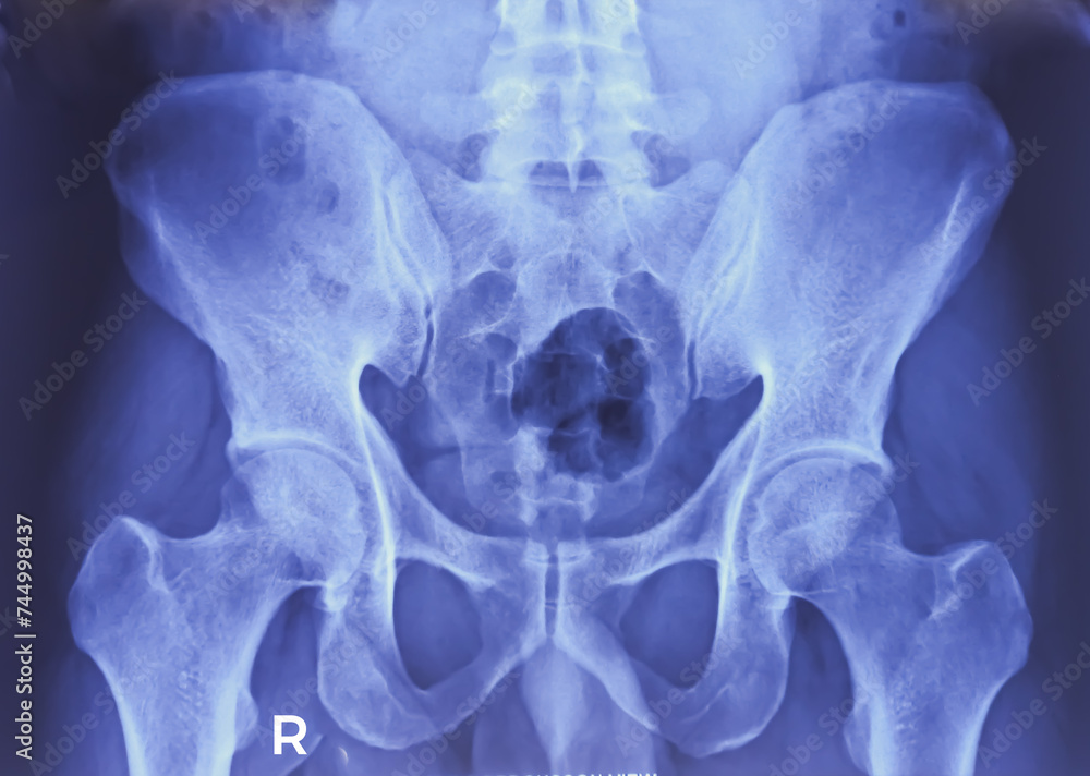 SI joint x-ray. Mild sclerosis at articular margin. Early sacroiliitis ...