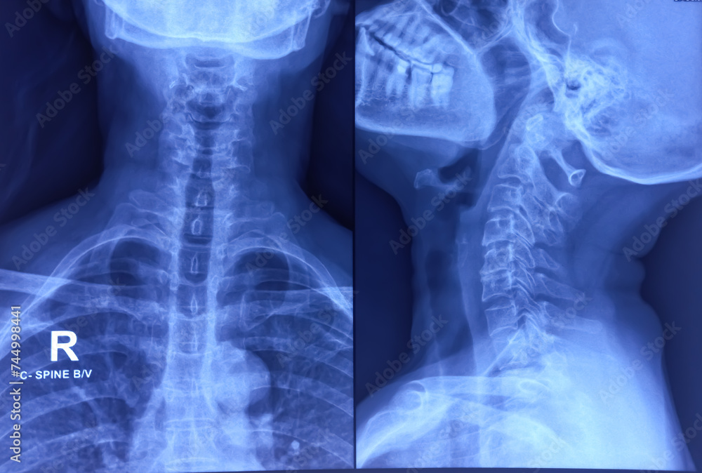 Cervical spine x-ray showing spondylosis of cervical spine. Marginal ...