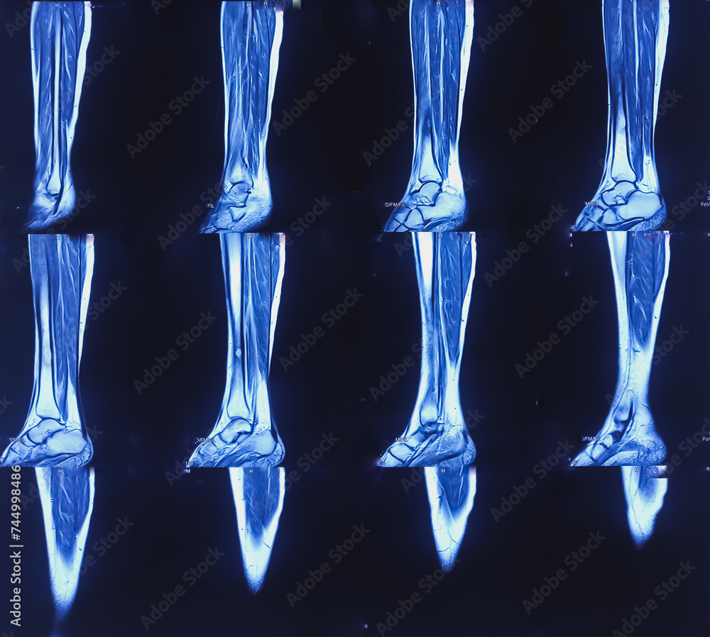 MRI (Magnetic resonance imaging) scan of leg. Lytic bony lesion at ...