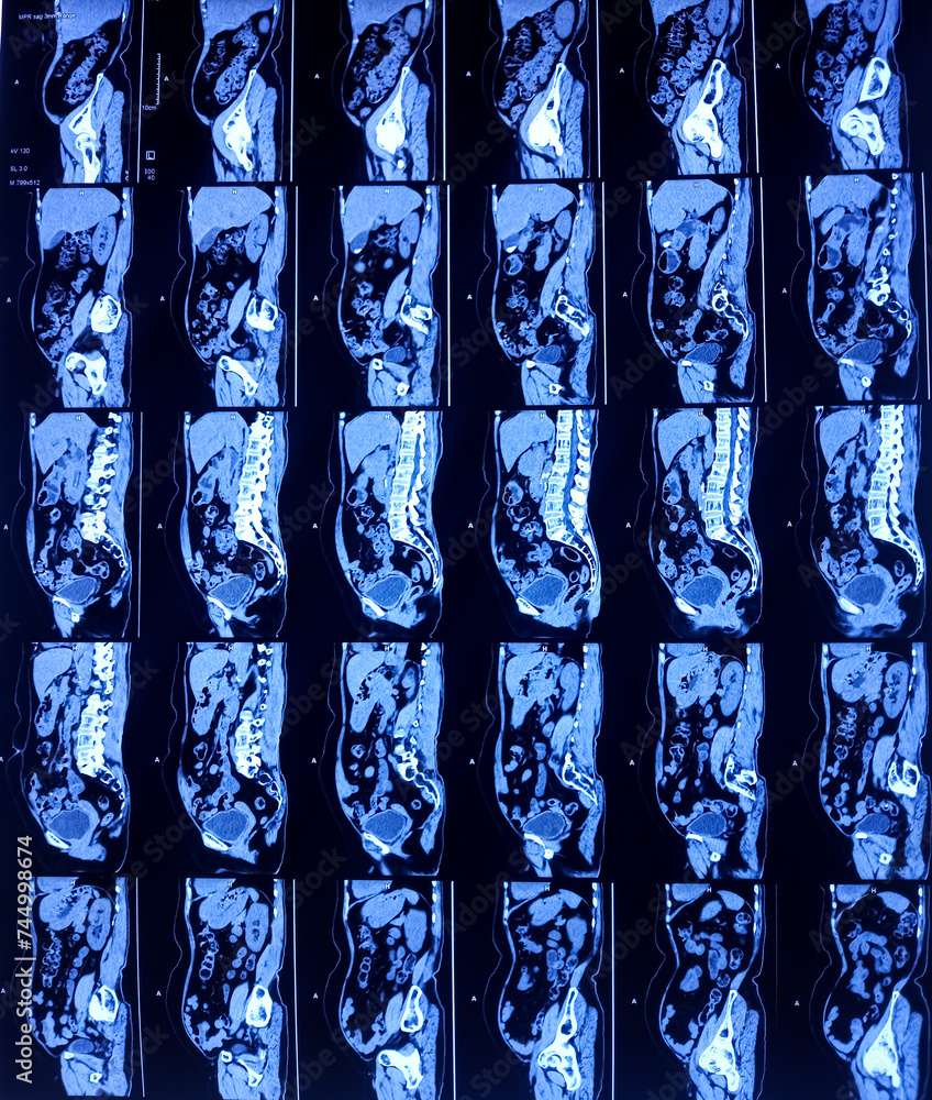 CT scan of KUB (non-contrast): Left renal tiny calculi (without ...