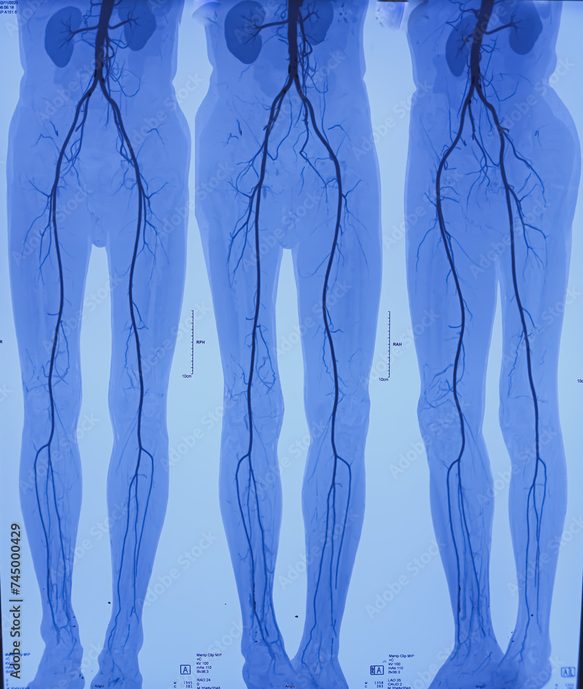CT angiogram (CTA) shown the abdominal aorta, kidney and common iliac ...