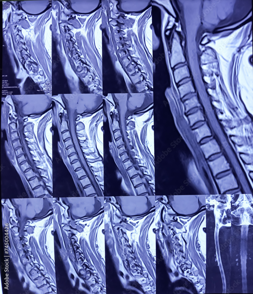 MRI of Cervical Spine and screening. Cervical spondyloarthropathy ...