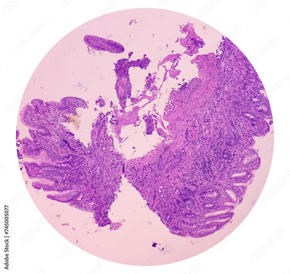 Tissue from antrum of stomach (endoscopic biopsy): Chronic nonspecific ...