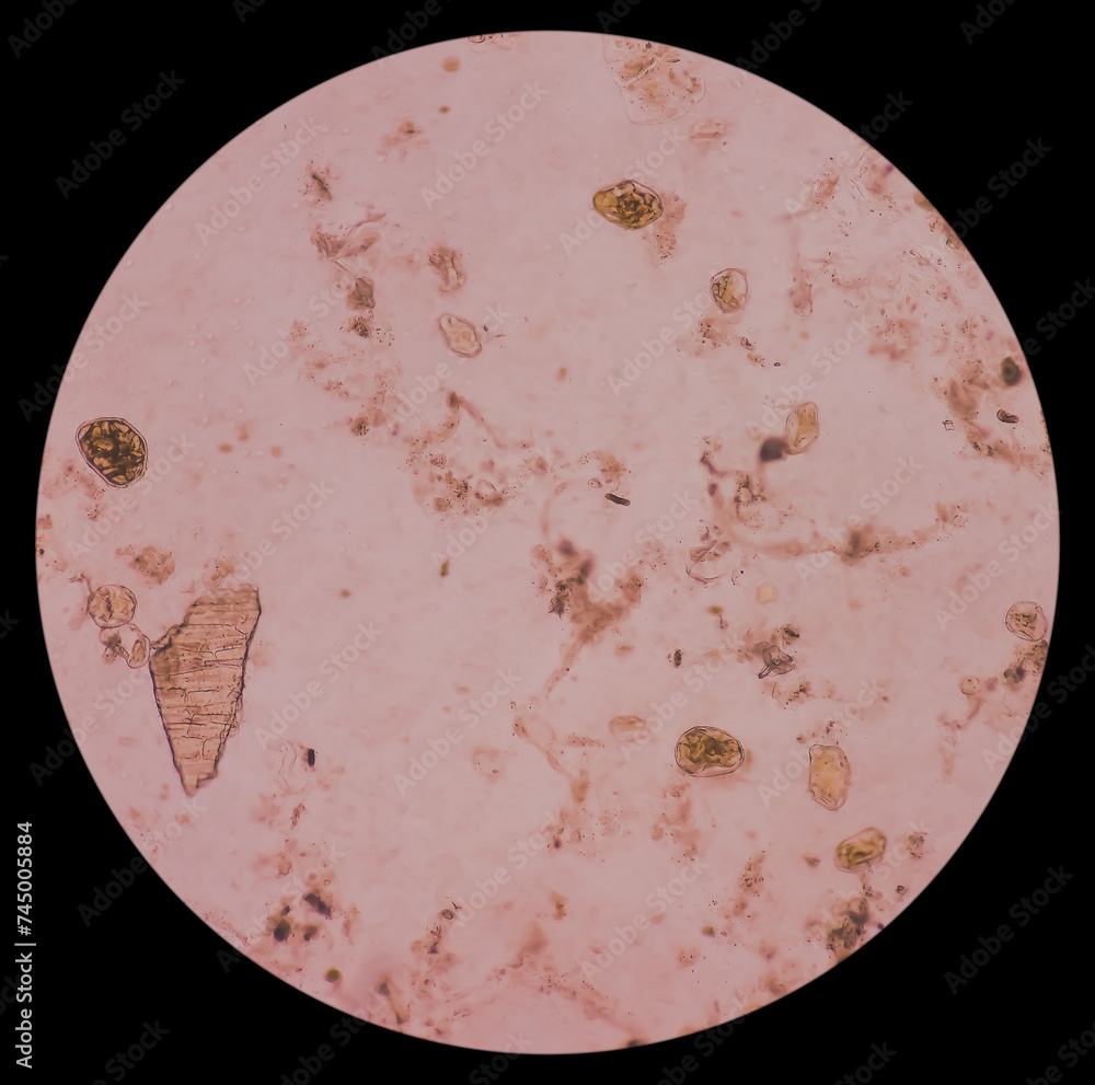 Giardia lamblia cysts and Trophozoite form, muscle fiber in stool ...