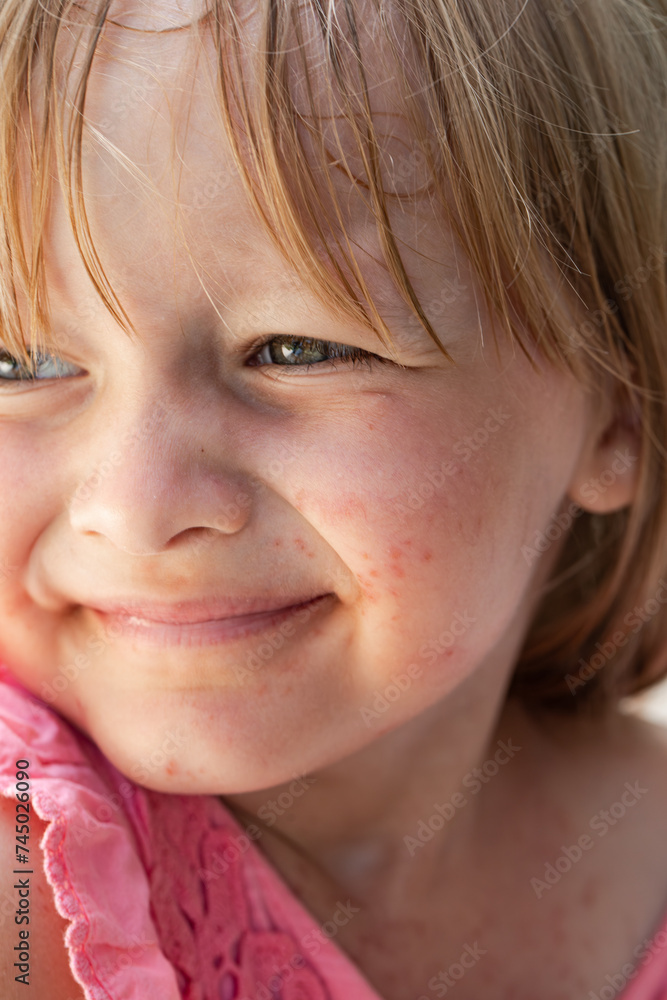 coxsackievirus, Singapore flu, skin rashes, blisters, viral infection ...