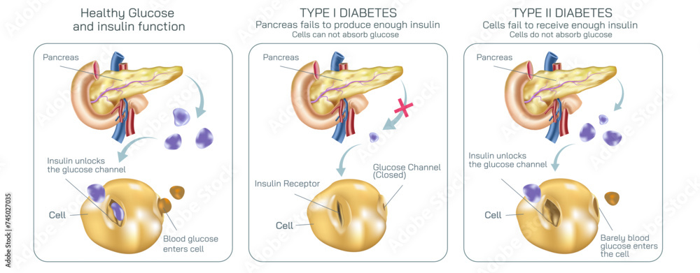 Vecteur Stock Difference between type one diabetes and type two ...