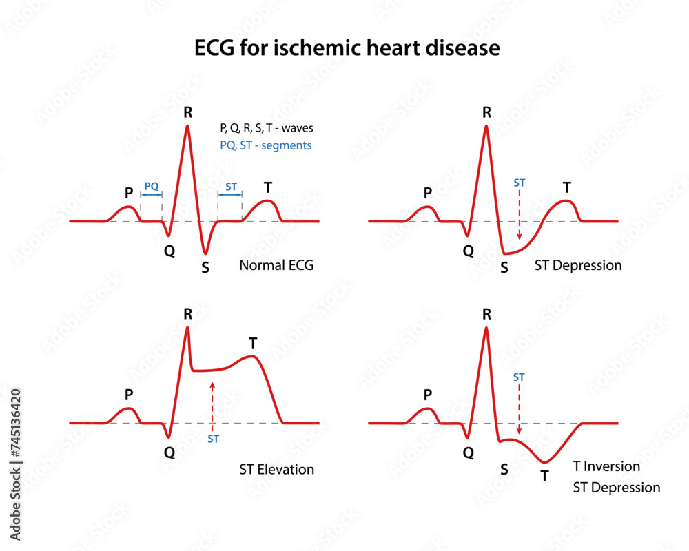 ECG for coronary heart disease. Types of coronary heart disease ...