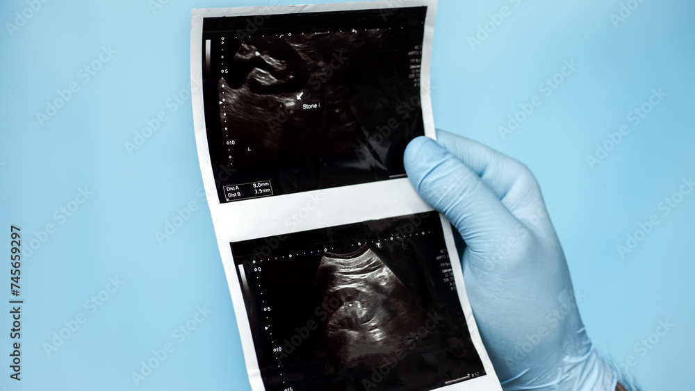 Male urinary tract disease. The calculus in the ureter is oxalate ...