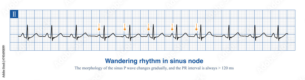When the dominant pacemaker of the sinus node changes within the sinus ...