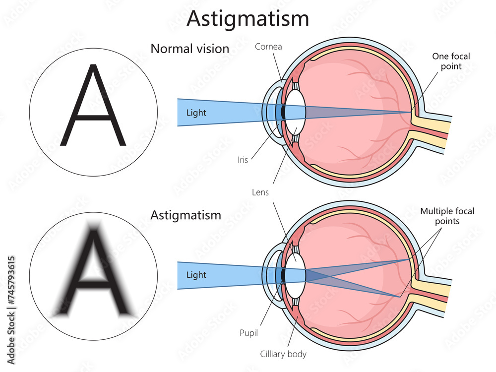 Astigmatism disorder medical structure diagram hand drawn schematic ...