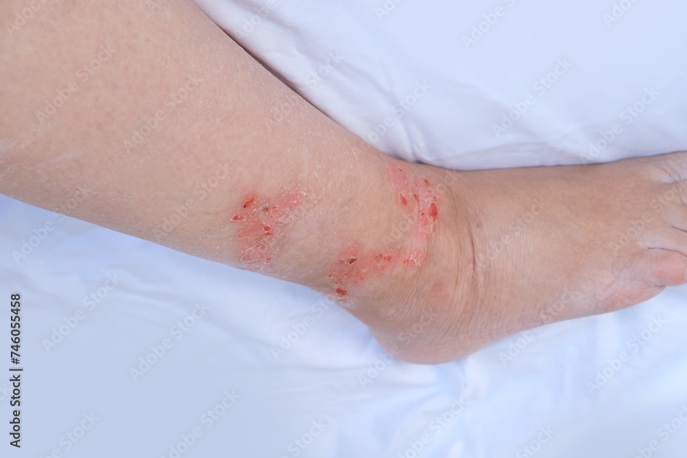 close-up injured female limb with damaged reddened skin, scratches ...