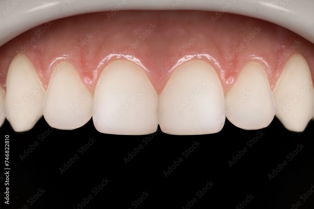 Close-Up Dentistry: Capturing the Intricacies of Teeth and Jaw Tooth ...