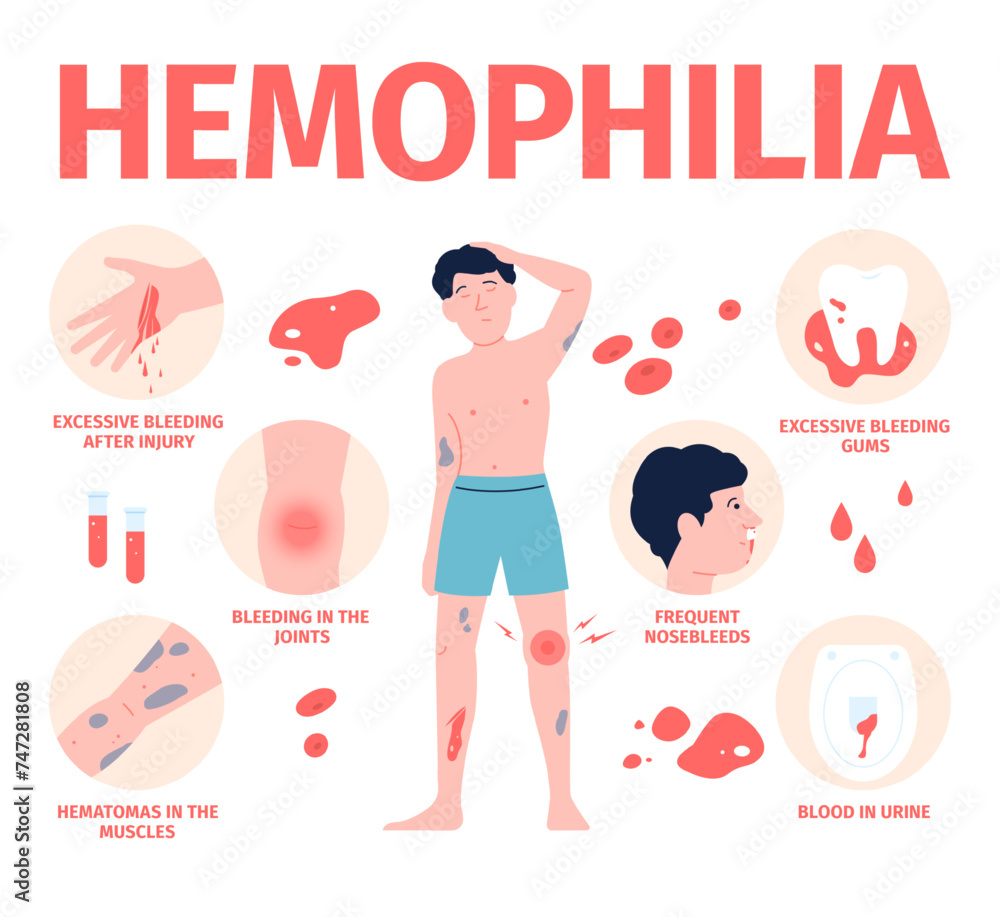 Hemophilia symptoms. Medical poster about men blood problems ...
