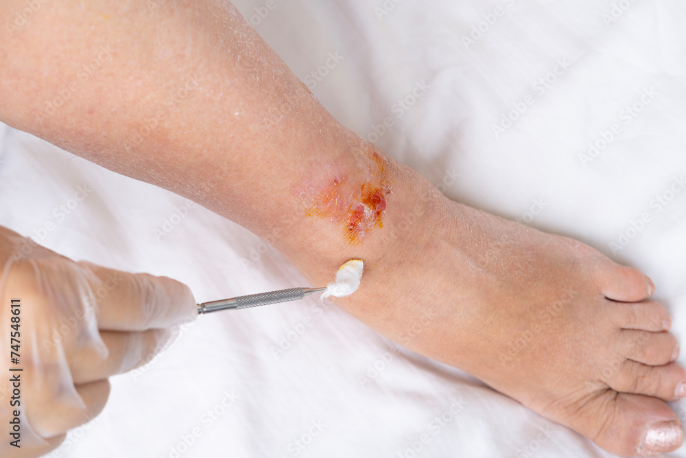 doctor treats healing wound from severe burn on leg adult female ...