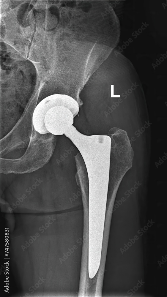 X-ray photo of left hip prosthesis. AP view. 12 weeks after total hip ...