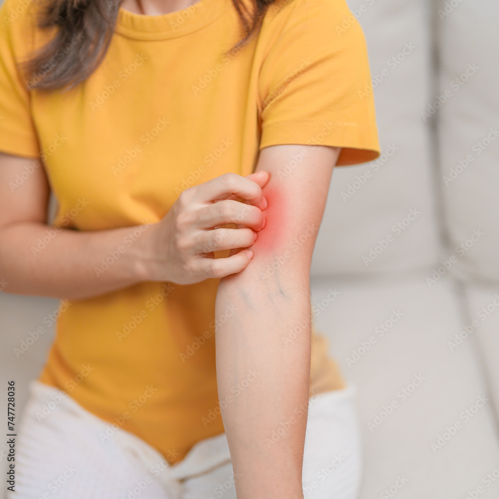 woman itching and scratching itchy arm. Sensitive Skin Allergic ...