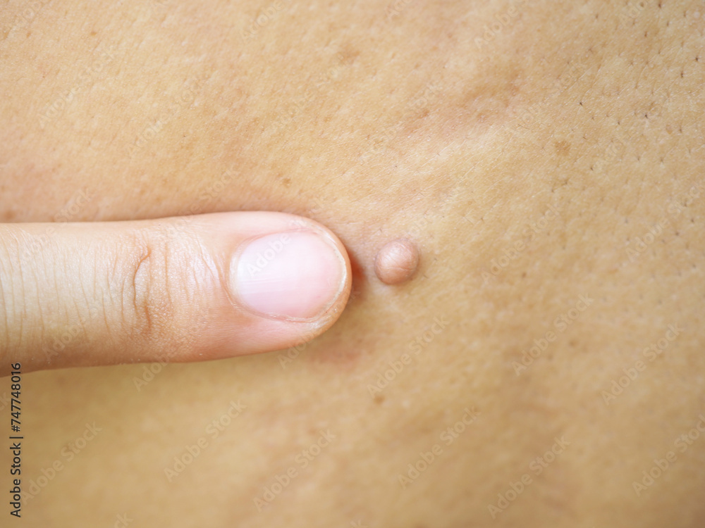 Pink mole on back asian man of skin lesion case of proliferation of ...