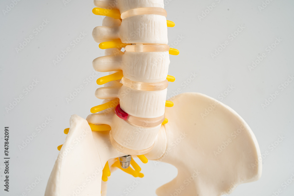Photo Lumbar spine displaced herniated disc fragment, spinal nerve and ...