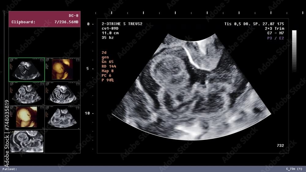 Prenatal diagnostic test of the fetus inside of the female womb. Using ...